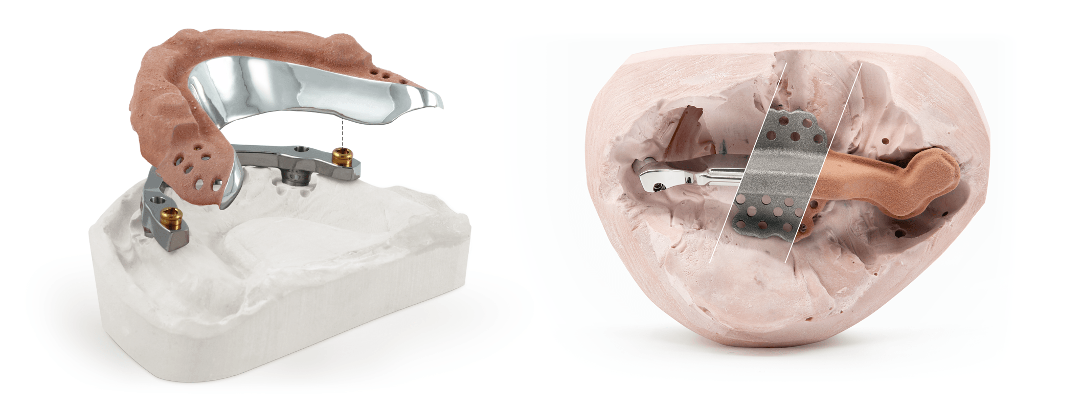 Panthera Dental | Double Structure for Metal Bar